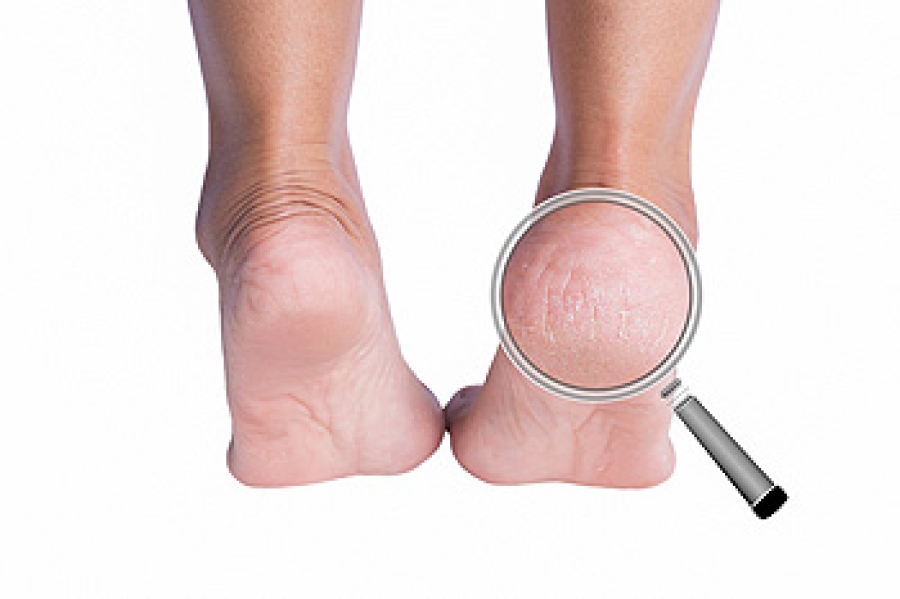 Understanding Skin Fissures on the Heels