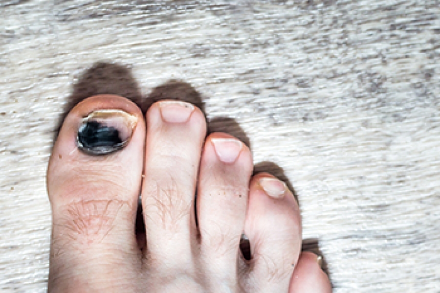 What Different Toenail Colors Signify
